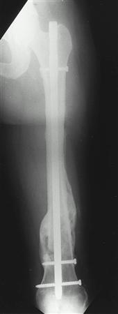 Normal Bone Metabolism Basic Science Orthobullets Articular Cartilage